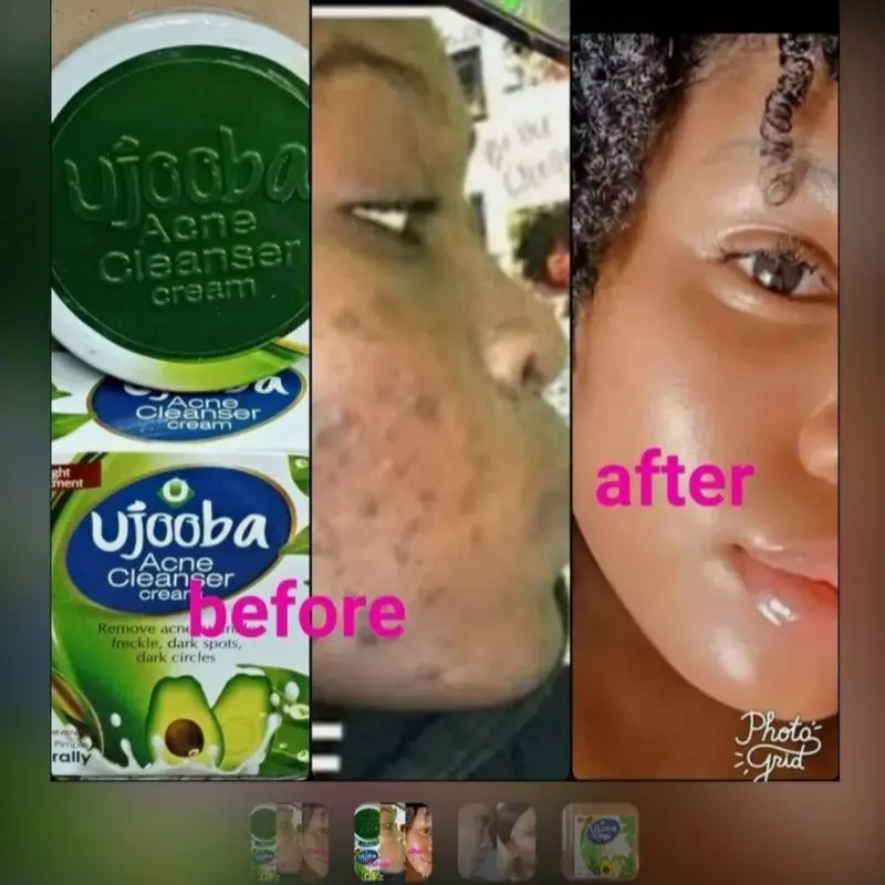 Ujooba Acne Cleanser Cream (30gm) – Aleena Cosmetics